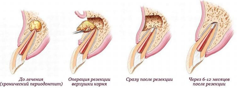 Tooth extraction in Yerevan, Armenia - GDC